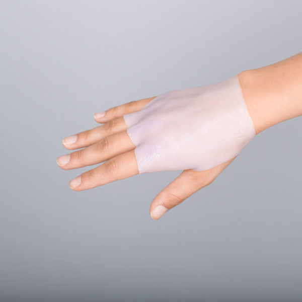 Suprathel - ideal wound dressing after Nexobrid - Eurosurgical